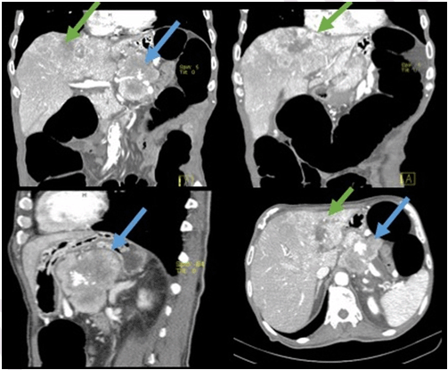 FULL TEXT - Cachexia, vomiting and an unexpected abdominal mass ...