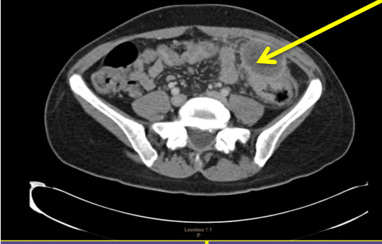 Symptoms Of Abscess In Abdomen