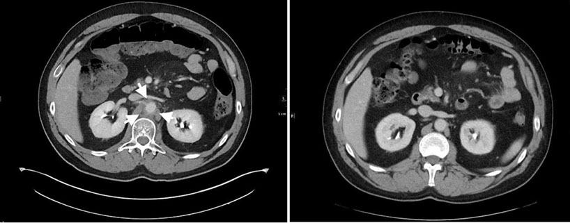 Abdominal aortitis with immune checkpoint inhibition - Journal of Case ...