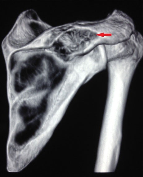 Primary neuroendocrine tumor of the scapula - Journal of Case Reports ...